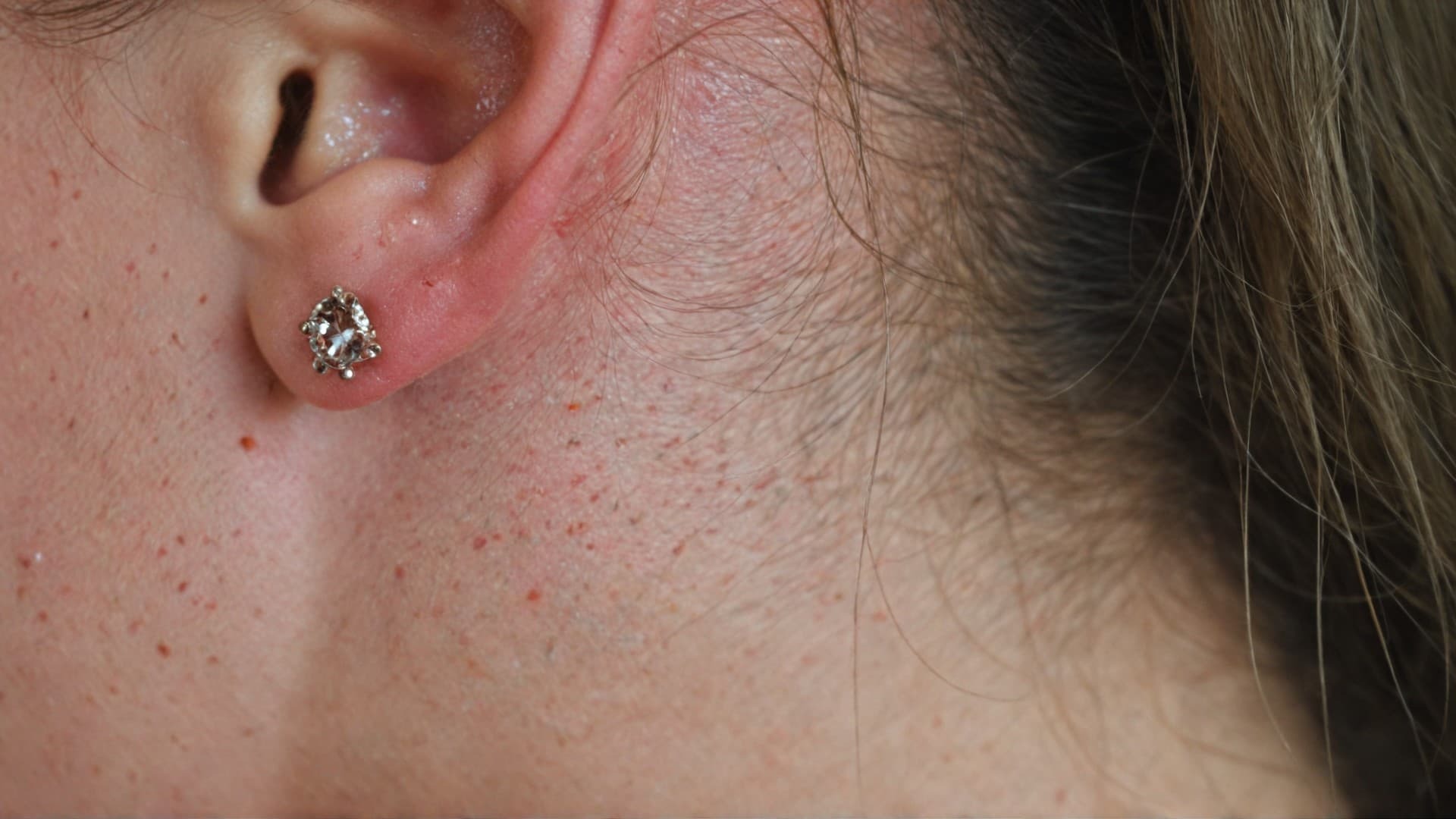 Can Jewelry Cause Acne or Skin Breakouts? – Nobbier